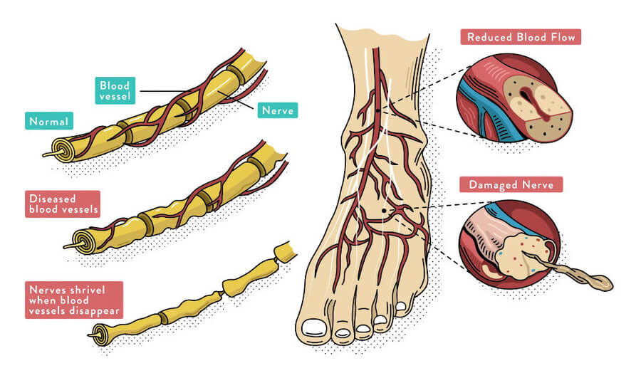 From Painkillers to Extinguishing My Neuropathy
